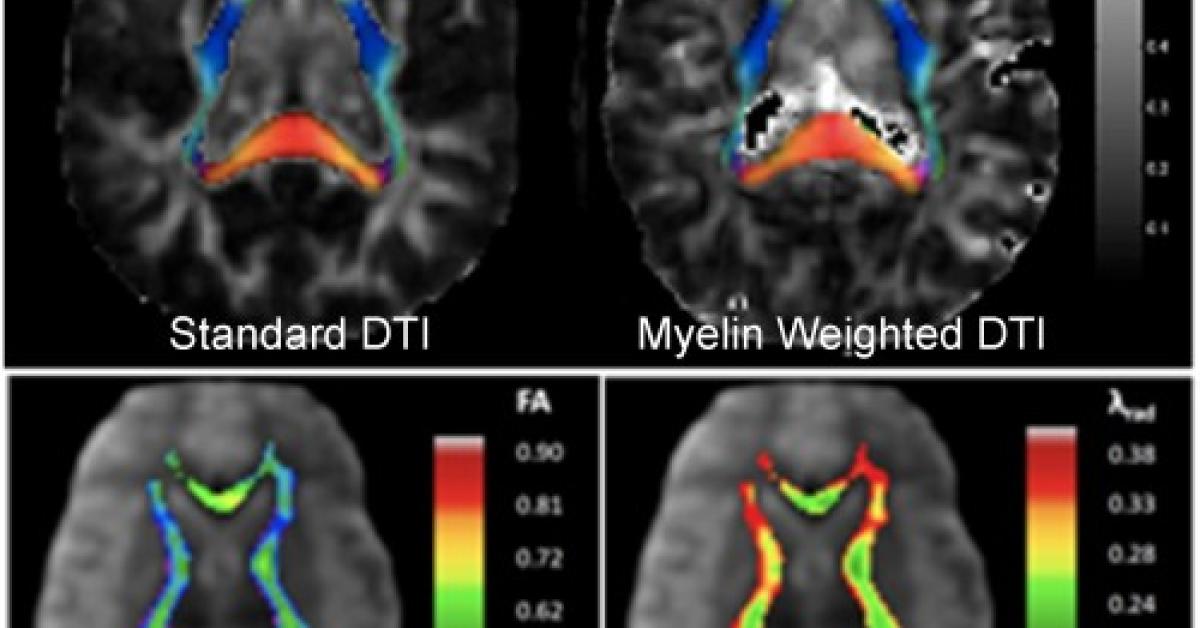 Myelin Water Weighted Diffusion Tensor Imaging | The Brain Imaging and Analysis Center