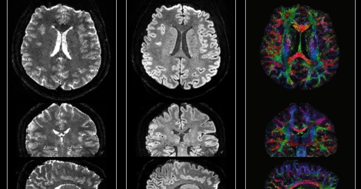 How MUSE is changing diffusion MRI | The Brain Imaging and Analysis Center