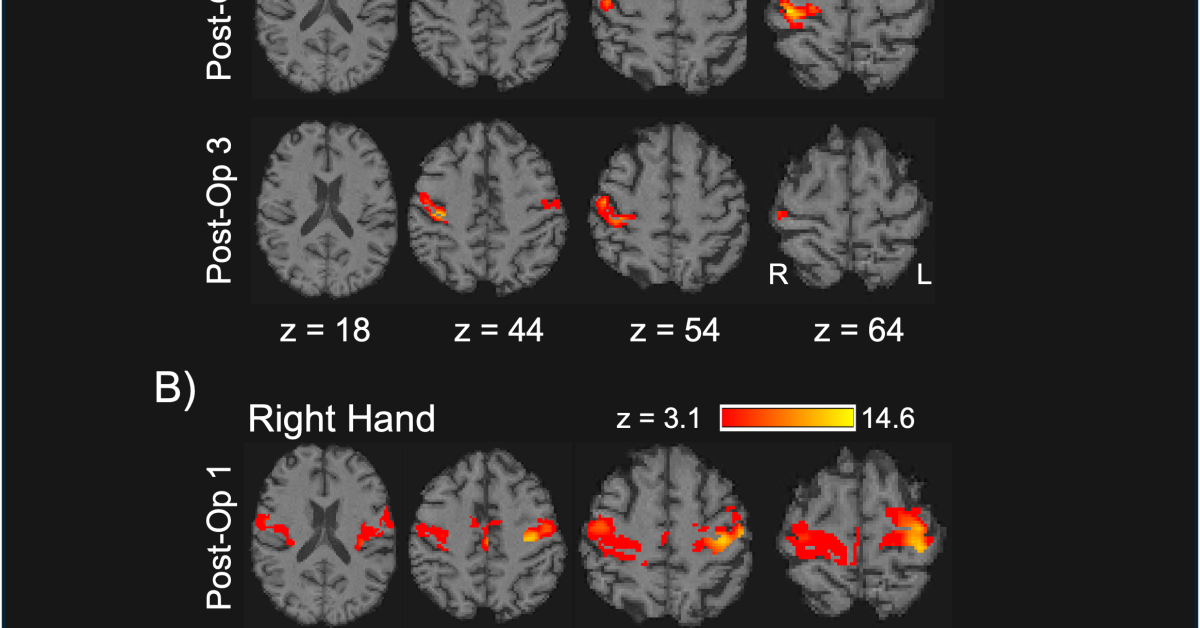 Neuroplasticity Following Hand Transplantation | The Brain Imaging and ...